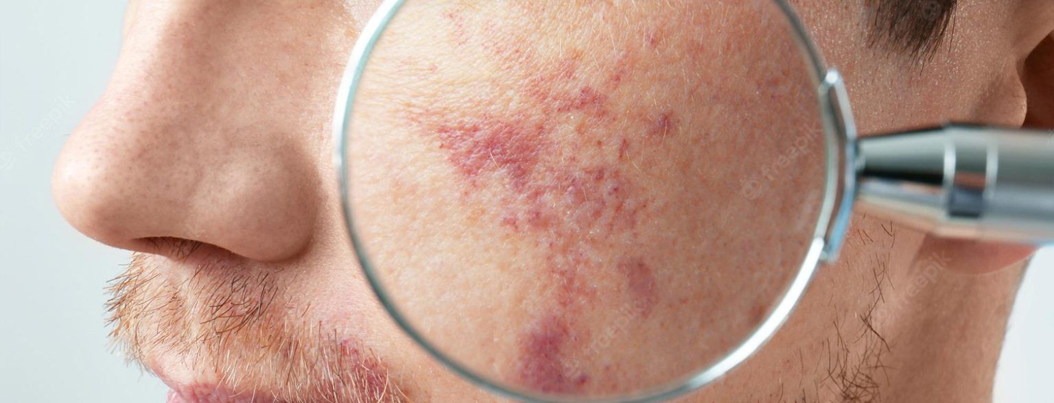 Birthmarks – NisClinic